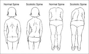 SCOLIOSIS - SPINE-ALINE